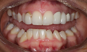 Treatment Decisions for Missing Maxillary Laterals Based on Case Types ...