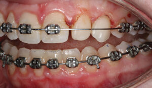Treatment Decisions for Missing Maxillary Laterals Based on Case Types ...