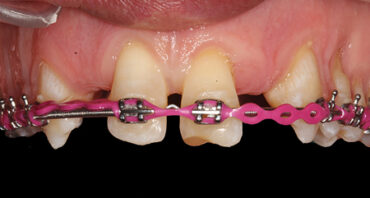 Treatment Decisions for Missing Maxillary Laterals Based on Case Types ...