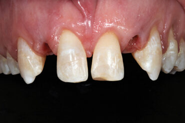 Treatment Decisions for Missing Maxillary Laterals Based on Case Types ...