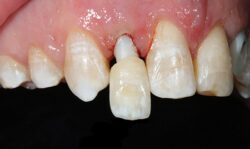 Treatment Decisions for Missing Maxillary Laterals Based on Case Types ...