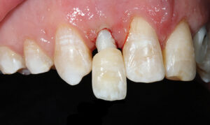 Treatment Decisions for Missing Maxillary Laterals Based on Case Types ...