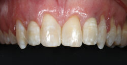 Treatment Decisions for Missing Maxillary Laterals Based on Case Types ...