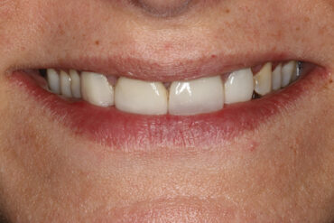 Treatment Decisions for Missing Maxillary Laterals Based on Case Types ...