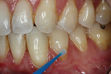 Treatment of Dental Sensitivity - Oral Health Group