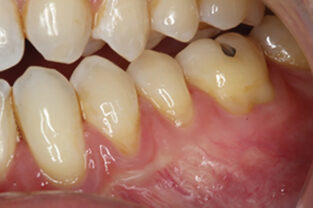 Treatment of Dental Sensitivity - Oral Health Group