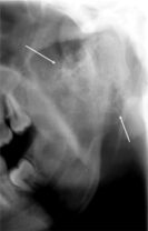 Tumors and Pseudotumors of the Temporomandibular Joint