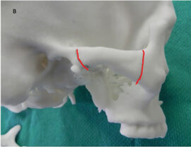 Tumors and Pseudotumors of the Temporomandibular Joint