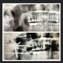 Tumors and Pseudotumors of the Temporomandibular Joint
