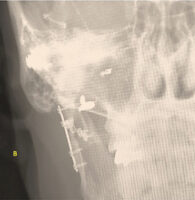 Tumors and Pseudotumors of the Temporomandibular Joint