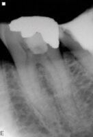 The Endodontic Triad: Dead or Alive? - Oral Health Group