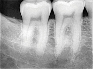 The Endodontic Triad: Dead or Alive? - Oral Health Group