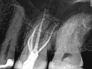 The Endodontic Triad: Dead or Alive? - Oral Health Group