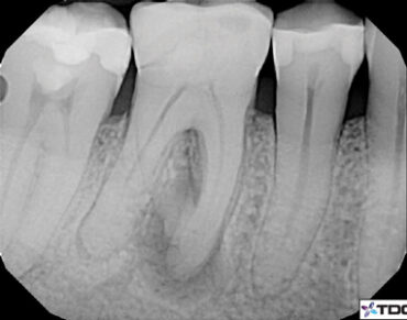 The Endodontic Triad: Dead or Alive? - Oral Health Group