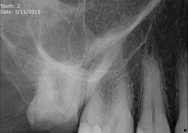 The Endodontic Triad: Dead or Alive? - Oral Health Group
