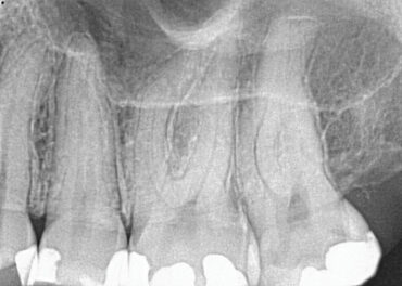 The Endodontic Triad: Dead or Alive? - Oral Health Group
