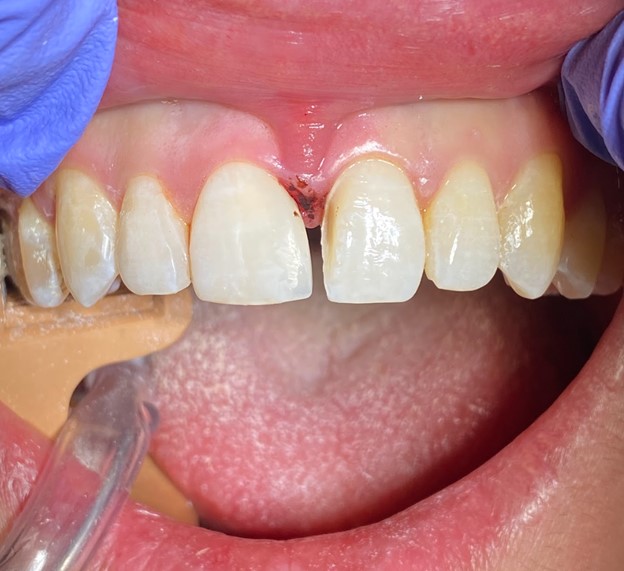 Finding a Place for Universal Composites in Esthetic Dentistry - Oral ...