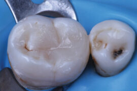 Preheating Composite Resins Using Composite Warmers