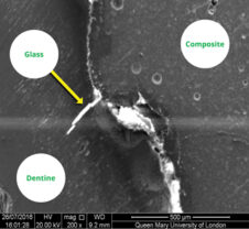 Bioactive Glass Technology in Preventive Dentistry - Oral Health Group
