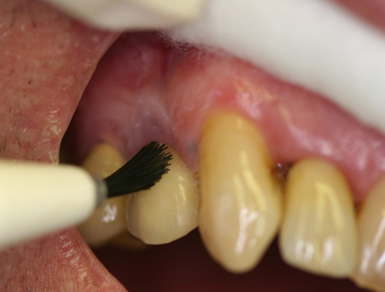 Prevora as a Successful Therapy for Oral Dysbiosis in High-risk ...