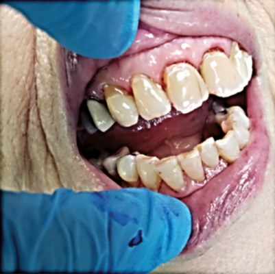 Prevora as a Successful Therapy for Oral Dysbiosis in High-risk ...