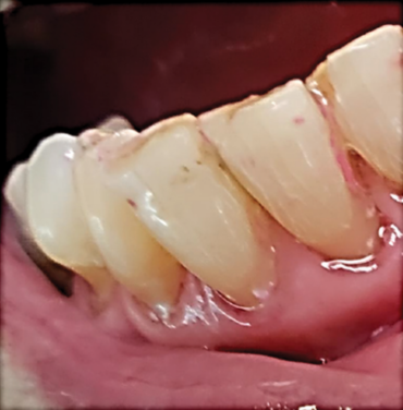 Prevora as a Successful Therapy for Oral Dysbiosis in High-risk ...