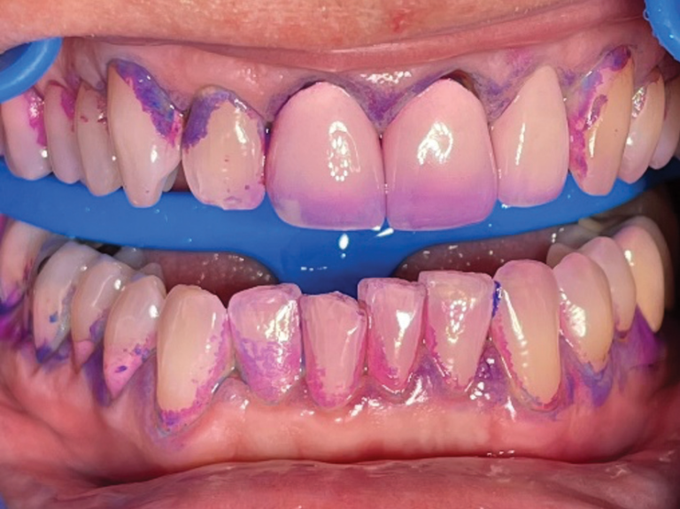 Prevora as a Successful Therapy for Oral Dysbiosis in High-risk ...