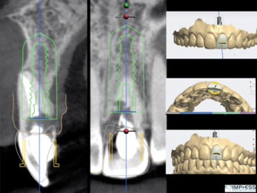 Keys for Successful Aesthetic Zone Single Implant: Case Reports