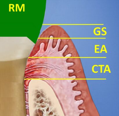 Managing and Maintaining the Periodontal-restorative Interface