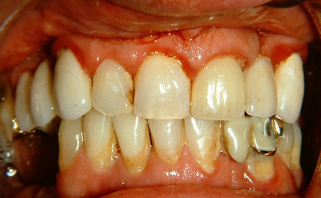 Managing and Maintaining the Periodontal-restorative Interface