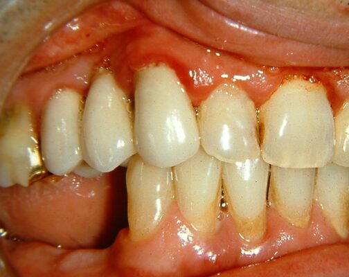 Managing and Maintaining the Periodontal-restorative Interface