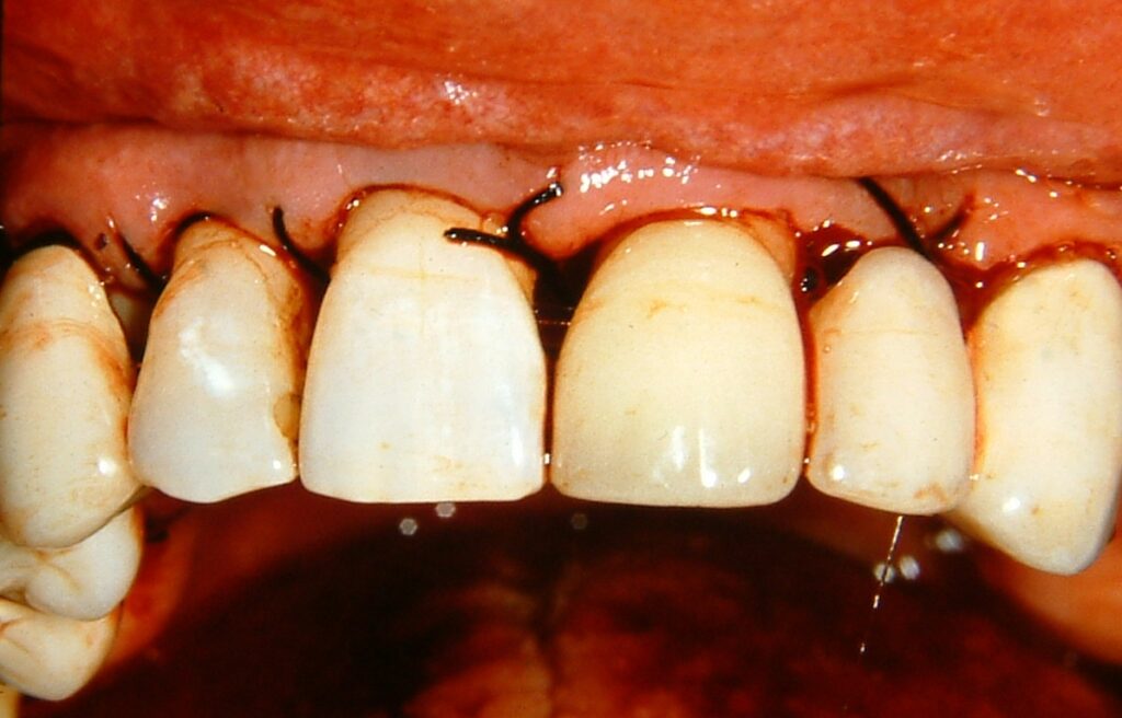 Managing and Maintaining the Periodontal-restorative Interface