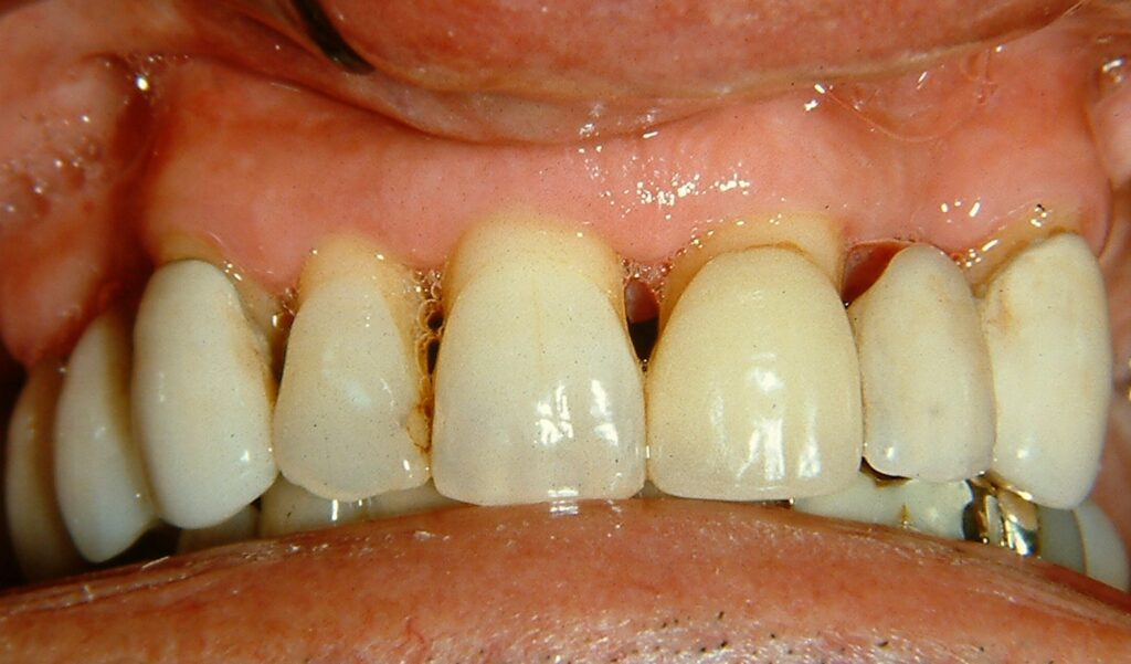 Managing and Maintaining the Periodontal-restorative Interface