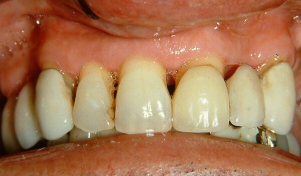 Managing and Maintaining the Periodontal-restorative Interface