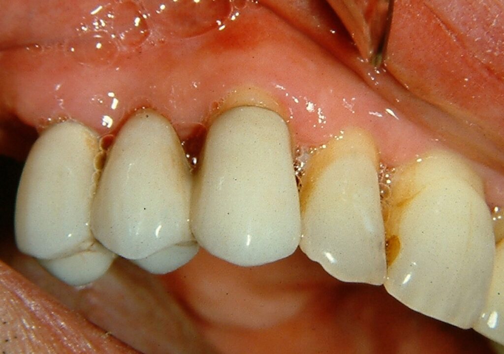 Managing and Maintaining the Periodontal-restorative Interface