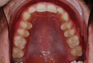 Treatment of a Class II Subdivision Type 2 Malocclusion with Customized ...