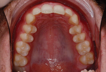 Treatment of a Class II Subdivision Type 2 Malocclusion with Customized ...