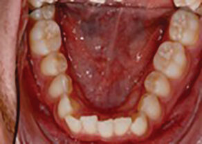 Treatment of a Class II Subdivision Type 2 Malocclusion with Customized ...