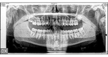 Treatment of a Class II Subdivision Type 2 Malocclusion with Customized ...