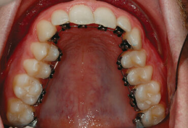 Treatment of a Class II Subdivision Type 2 Malocclusion with Customized ...