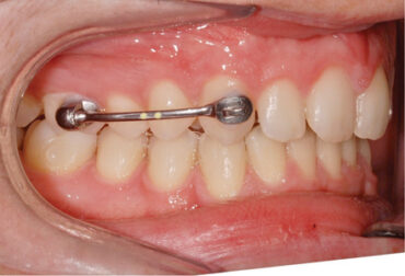 Treatment of a Class II Subdivision Type 2 Malocclusion with Customized ...