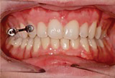 Treatment of a Class II Subdivision Type 2 Malocclusion with Customized ...