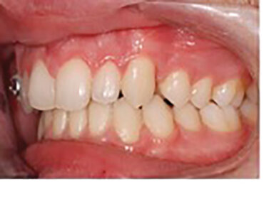 Treatment of a Class II Subdivision Type 2 Malocclusion with Customized ...