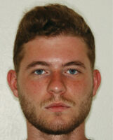 Treatment of a Class II Subdivision Type 2 Malocclusion with Customized ...