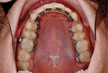 Treatment of a Class II Subdivision Type 2 Malocclusion with Customized ...