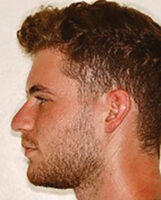 Treatment of a Class II Subdivision Type 2 Malocclusion with Customized ...