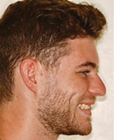 Treatment of a Class II Subdivision Type 2 Malocclusion with Customized ...