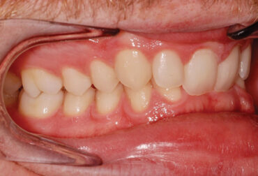 Treatment of a Class II Subdivision Type 2 Malocclusion with Customized ...