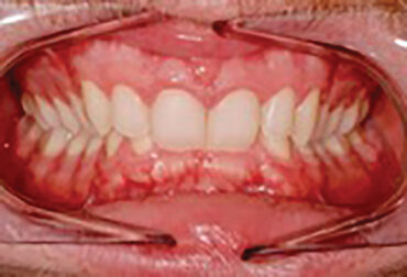 Treatment of a Class II Subdivision Type 2 Malocclusion with Customized ...