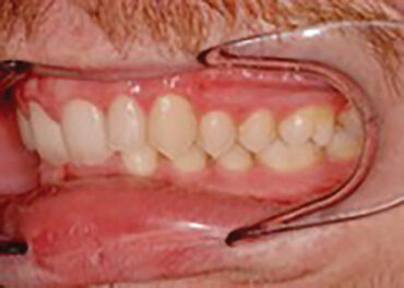 Treatment of a Class II Subdivision Type 2 Malocclusion with Customized ...